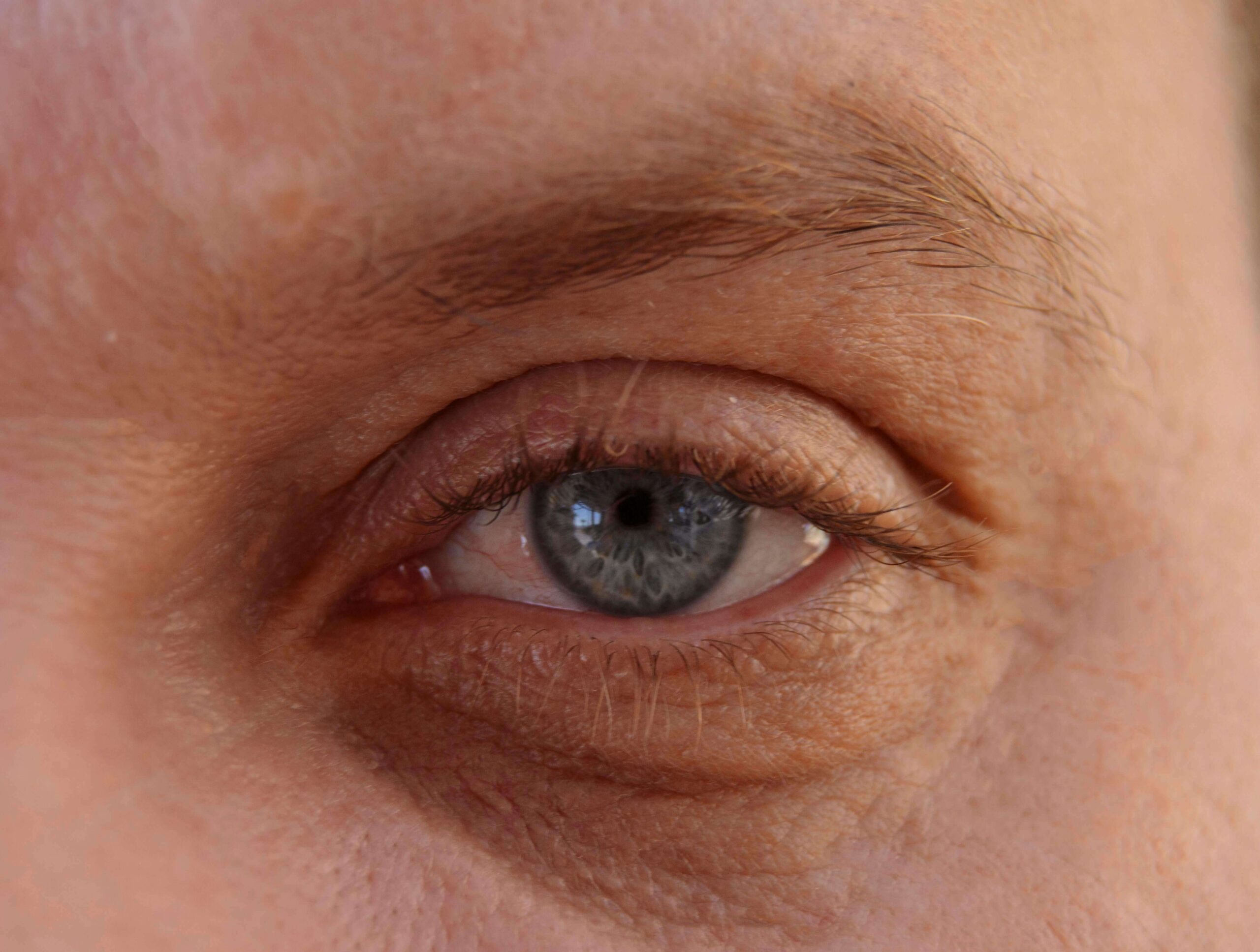 Tipos de ojeras: causas y tratamientos | HerboGreen